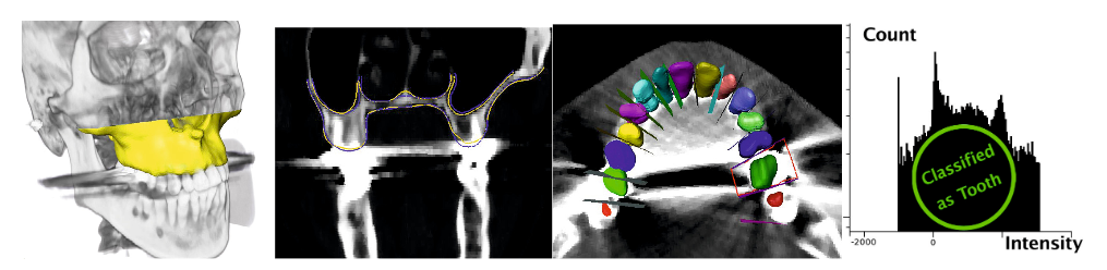 Automatic Detection And Classification Of Teeth In Ct Data Hans Lamecker