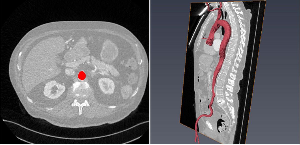 Deep Learning and Image Pyramids for Aorta Segmentation | Hans Lamecker