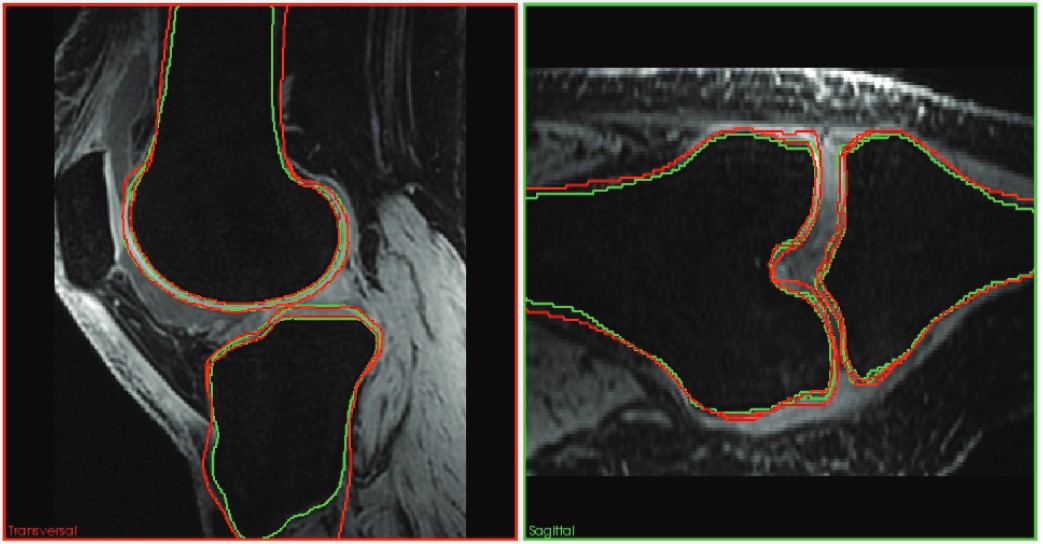 Model Based Auto Segmentation of Knee Bones and Cartilage in MRI Data | Hans Lamecker