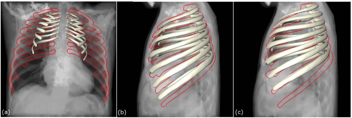 Towards Model Based 3-D Reconstruction of the Human Rib Cage From ...